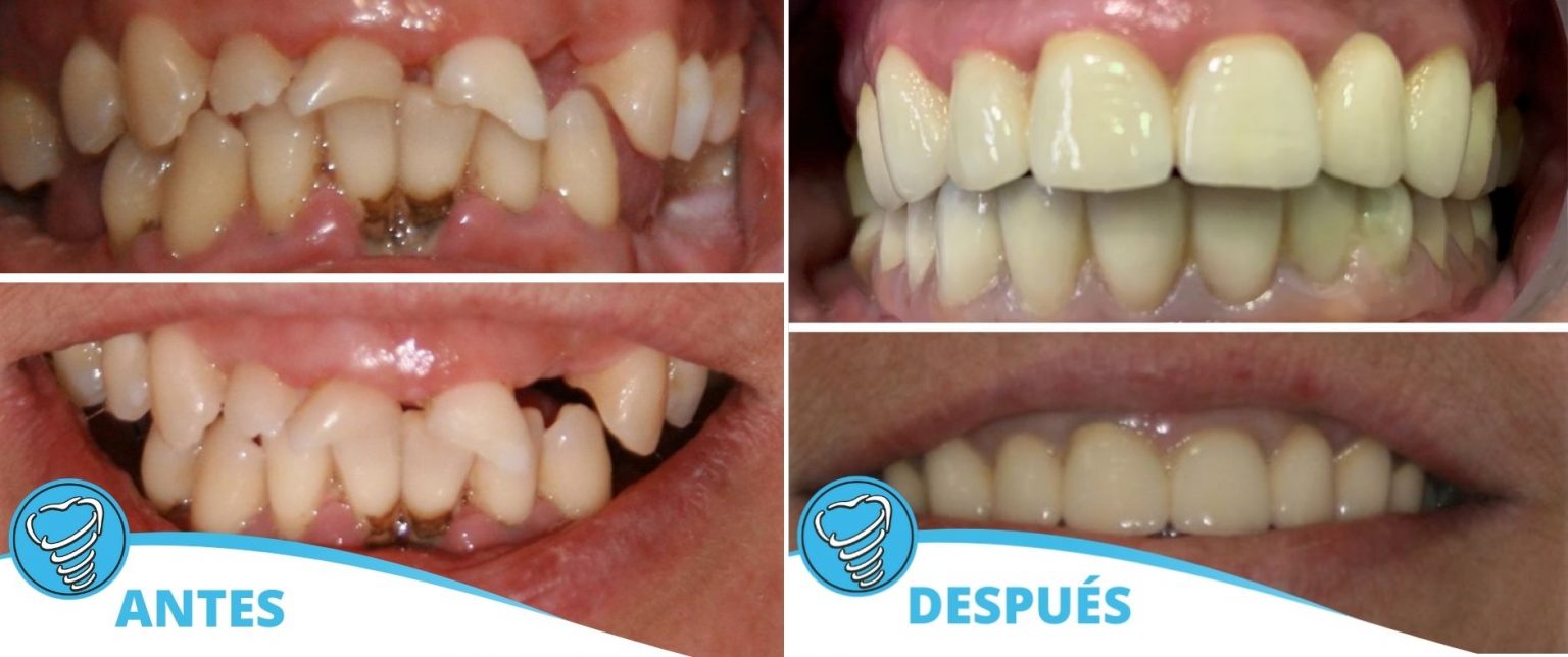 Rehabilitación Completa Superior e Inferior con aumento de Dimensión ...